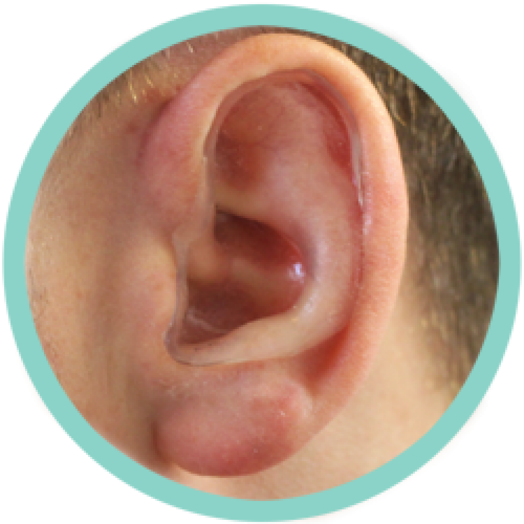 Mother of Rugby Player Invented Her Own Cauliflower Ears Protection ...